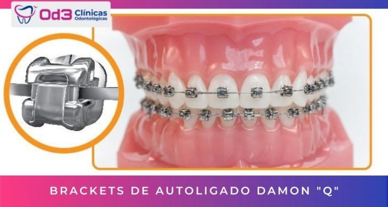 Brackets de Autoligables – Brackets Damon – Lima 2025 – OD3 Clínicas ...